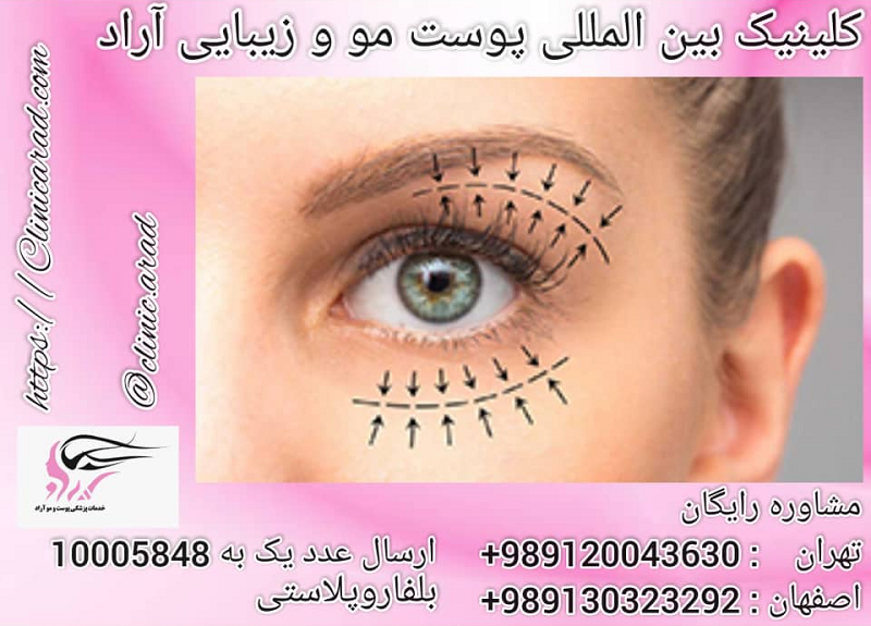 جراحی زیبایی پف زیر چشم در اصفهان - کلینیک بین المللی پوست و مو زیبایی ...